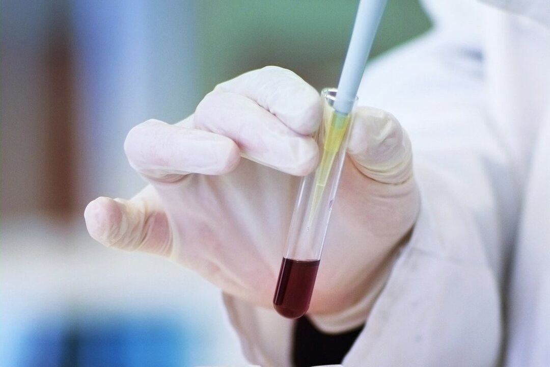 Normalna razina šećera u krvi za žene i muškarce. Razina šećera u krvi ...